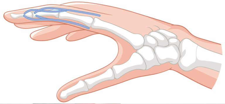 Boutonniere Deformity: Causes, Symptoms, Diagnosis & Treatment |Physio ...