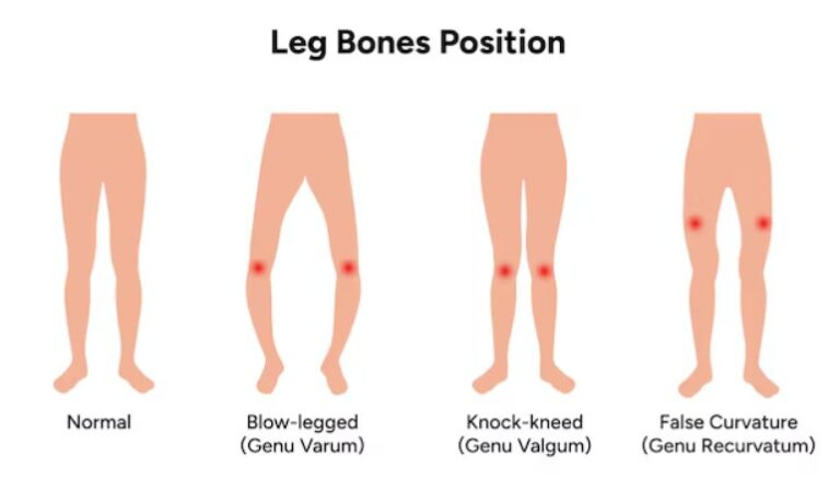 Genu Valgum and Genu Varum: Understanding Knee Alignment and Its ...